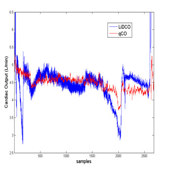 Comparison of Two Cardiac Output Monitors, qCO and LiDCO, During ...