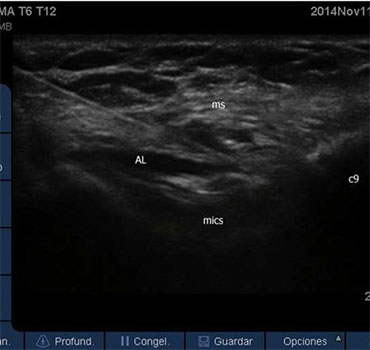 Ultrasound-Guided Intercostal Nerves (Cutaneous Branches) Block ...